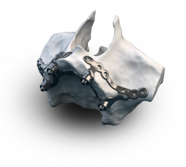 Implantes customizados | Phibo